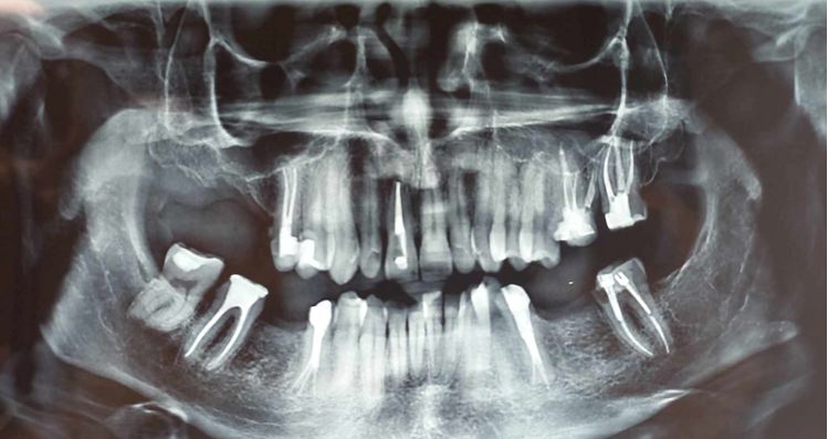 Traitement endodontique - Clinique Dentaire Mont Blanc